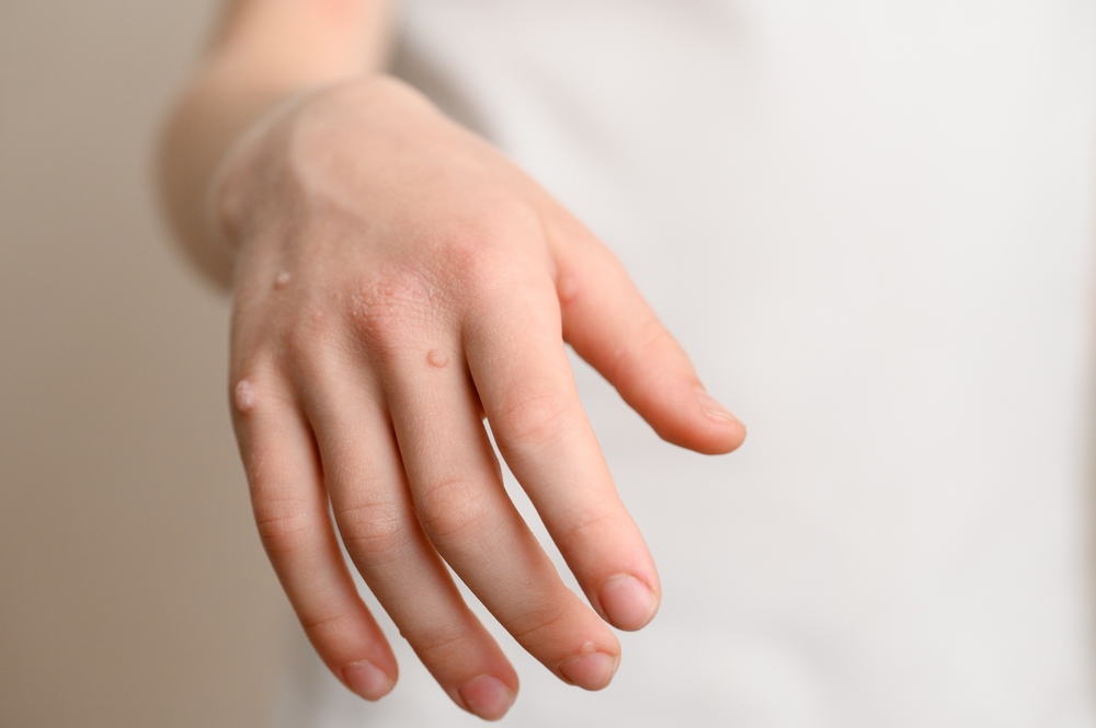 Why Winter is the Perfect Time for Wart Removal with Dr. David Baird ...